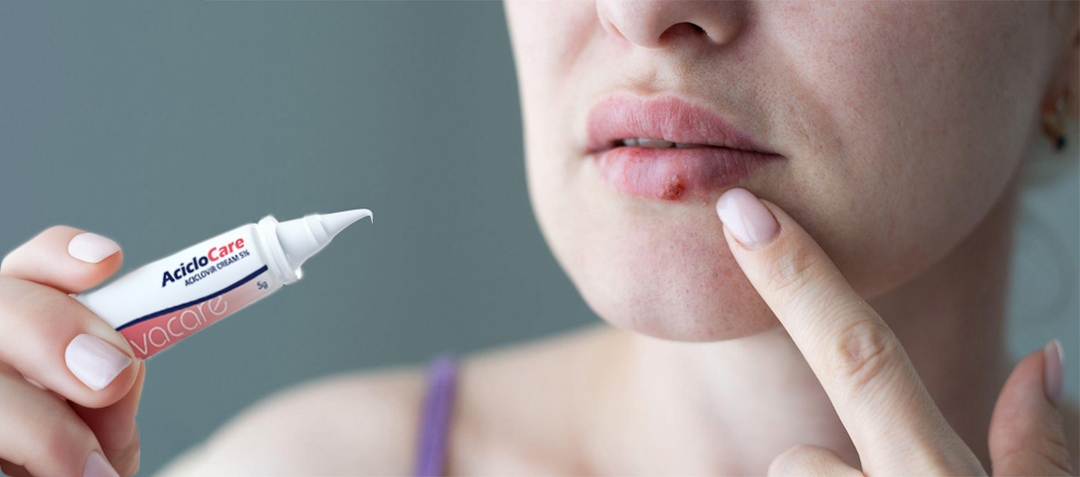 Aciclovir Creams and Treatment of Herpes Simplex | AdvaCare Pharma